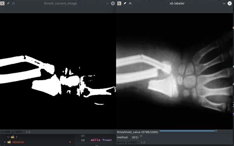 Python Image Threshold Algorithms To Use On An X Ray Image And Detect