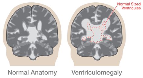 Learn About A Ventriculomegaly Diagnosis During Pregnancy