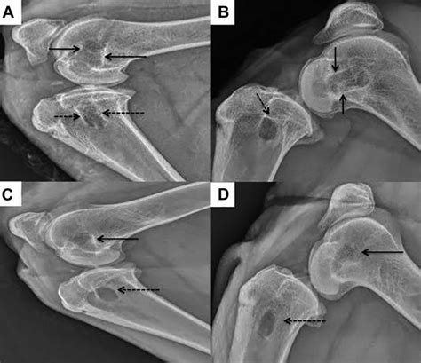 Representative Lateral Radiograph Showing The Femoral Bone Tunnel