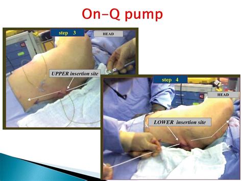 Ppt Novel Treatments Of Rib Fractures Hype Or Future Powerpoint