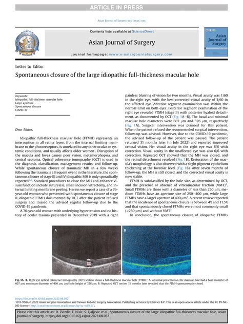 Pdf Spontaneous Closure Of The Large Idiopathic Full Thickness Macular Hole