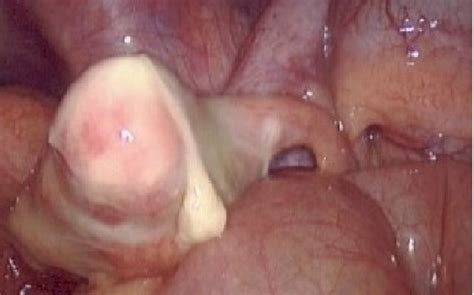 Inflamed Appendix On Laparoscopy Download Scientific Diagram