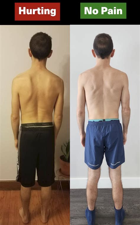 How To Fix Scapular Winging Typical Exercises Dont Work — Functional Patterns Brisbane