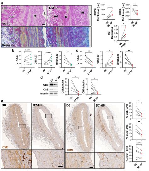 high pressure perfusion decreases cse expression in human vein