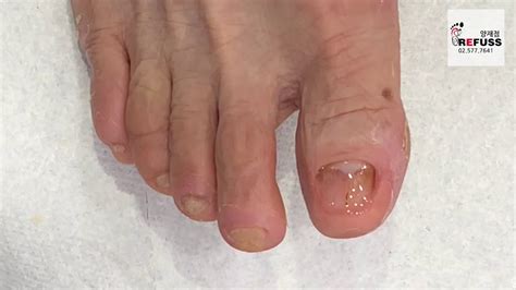문제성발톱 레진젤로 관리해요 레진젤 발톱 복원 Youtube