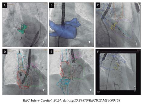 Role Of Computed Tomography In Transcatheter Coronary And Structural