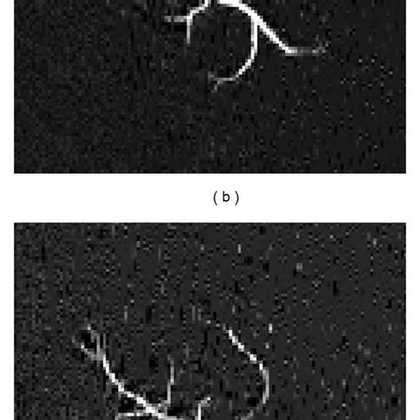 Image Reconstructions Using The Adm Algorithm With 40 Detection Angles
