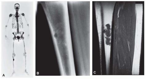 Chondroma Musculoskeletal Key