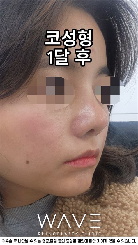 웨이브의원 2015년부터 자가늑연골and무보형물 비염and비중격 내 인생의 마지막 코성형재수술 웨이브의원은 비염 비중격만곡증 비염 비밸브 협착증 해당 시 의료 실비보험이