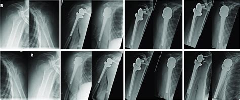 Comparison Of Abduction And Adduction Anteversion And Retroversion Download Scientific