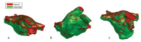 Comparison Of 3d Shape Between The Manual And Automatic Segmentation In