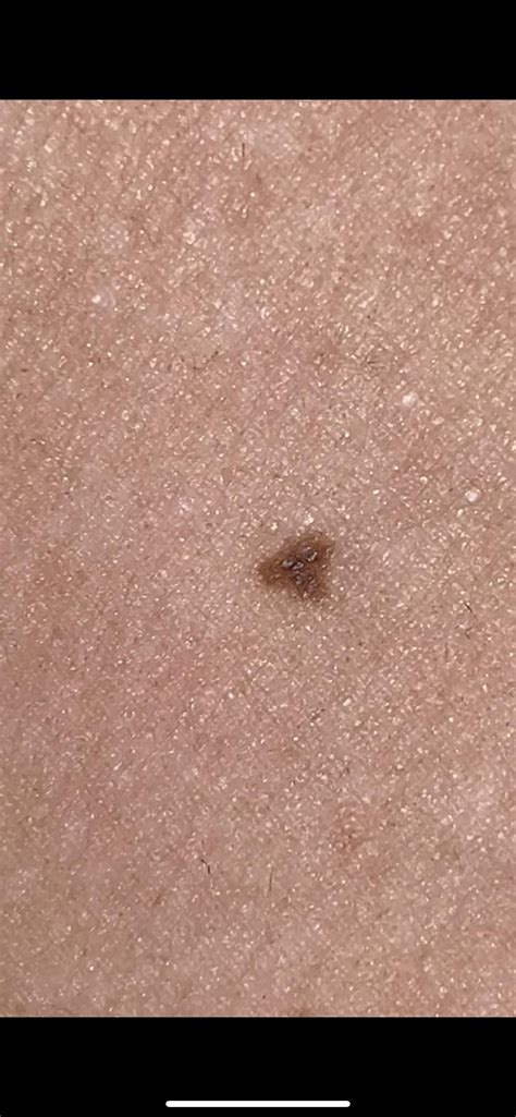 Concerning Mole Rmelanoma