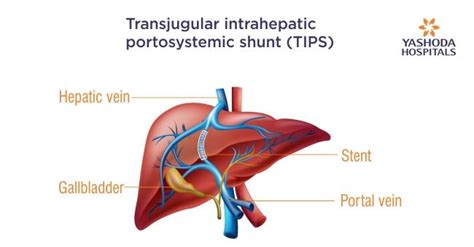 Transjugular Intrahepatic Portosystemic Shunt Diagram Treatment Of