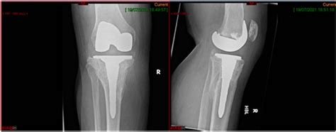 6 Month Post Operative Knee Replacement Download Scientific Diagram