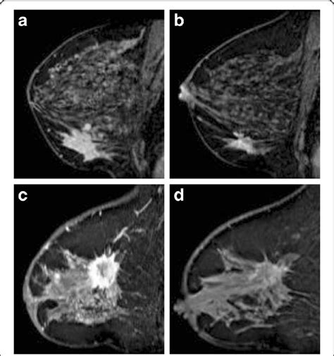 Example Of A Tumor That Shrinks Concentrically Magnetic Resonance Download Scientific Diagram