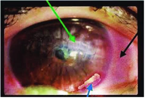 Klebsiella Oxytoca Induced Keratitis Showing Hypopyon Redness Ulcer
