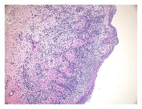 The Pathogenesis Of Odontogenic Cysts A Review Browne 1975 40 Off