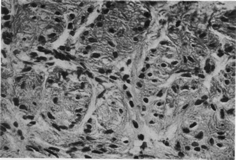 Testicular Biopsy Showing Diffuse Interstitial Fibrosis Tubular Download Scientific Diagram