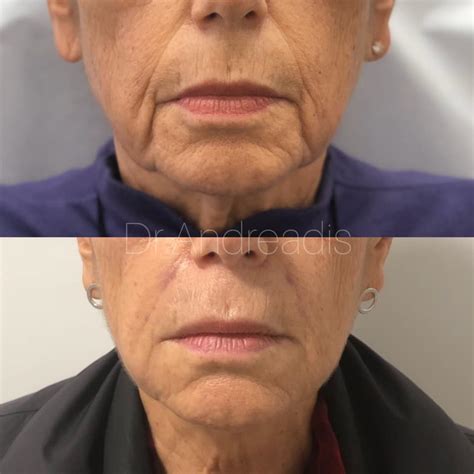 Dr Andreadis Dr Andreadis Ioannis Plastic Surgery
