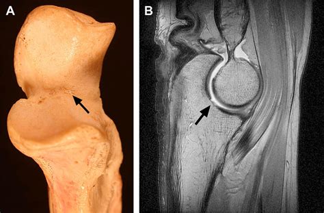 Trochlear Groove And Trochlear Ridge Anterior View Of The Trochlear Download Scientific