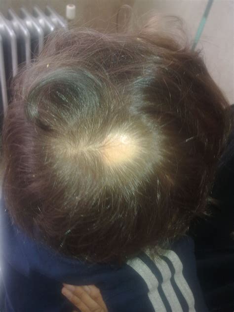 Missing Proteins Lead To Rare Congenital Scalp Defect