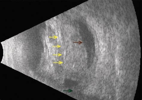 B Scan Ultrasound Image Of A Patient With Extensive Suprachoroidal
