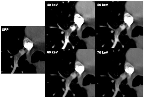 Impact Of Photon Counting Detector Ct Derived Virtual Monoenergetic