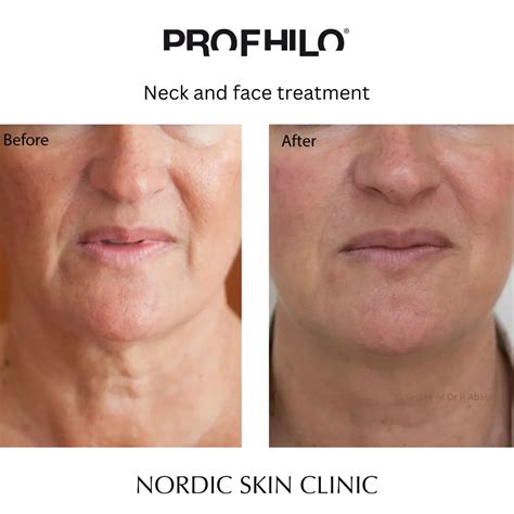 Profhilo Treatment Nordic Skin Clinic