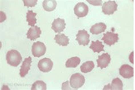 Hypoproliferative Anemias Flashcards Quizlet