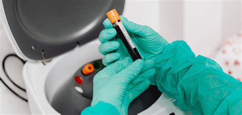 Volumetric Absorptive Microsamplinglcmsms Assays For Quantitation Of
