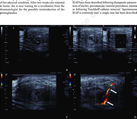 Ultrasound Us Guided Percutaneous Embolization Of The Pseudoaneurysm