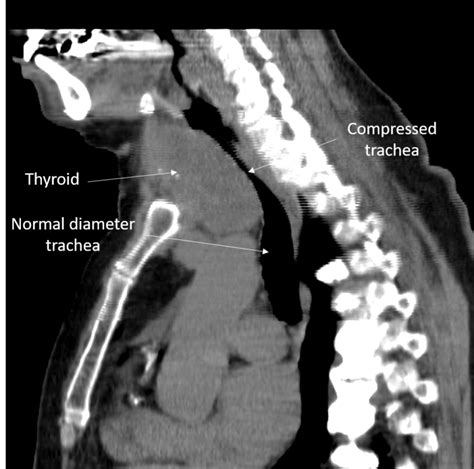 Thyroid Nodules And Cancer Hyperexcision