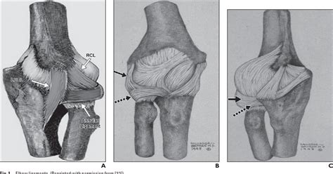Figure 1 From Mri Of The Annular Ligament Of The Elbow Review Of