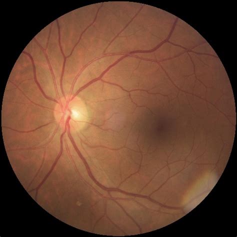 Retinal Disease Classification Classification Dataset By Karthikeyanphdworks