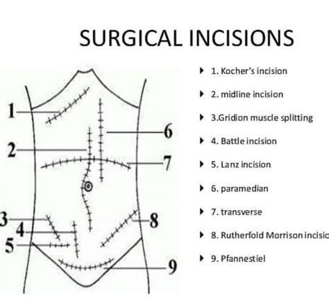 Surgical Incision Names At Ima Welliver Blog