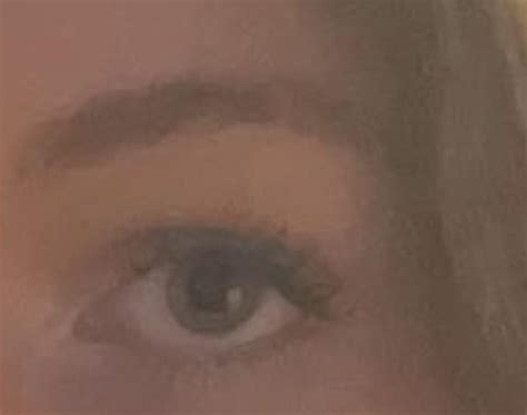 Hypomanic Vs Depression Eyes Rbipolar2