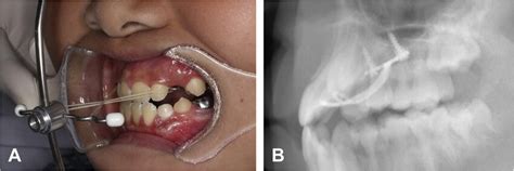 Photograph And Radiographic Image After Placement A Application Download Scientific Diagram