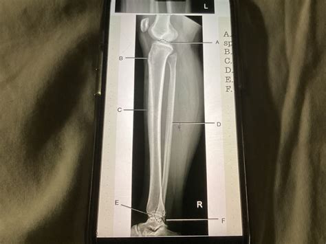 Lowers Week Tib Fib Diagram Quizlet Lowers Week Tib Fib Diagram Quizlet