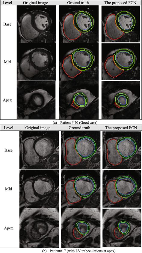 The Segmentation Results For Three Different Levels Base Middle And