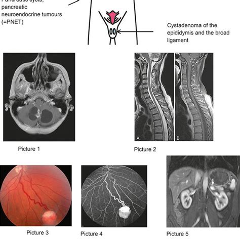 Picture 1 T1 Weighted Image Of The Cerebellum With Bilateral Cystic