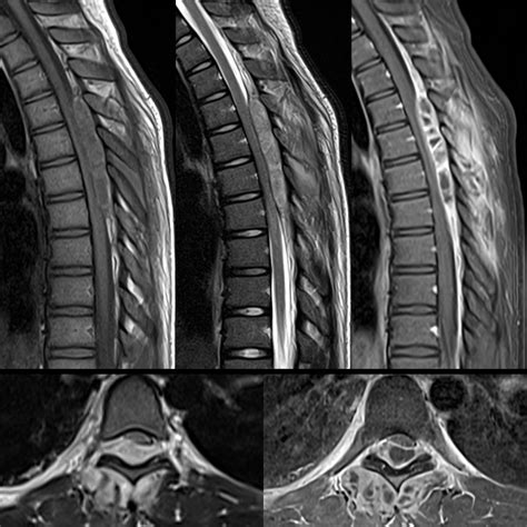 Pediatric Spinal Epidural Abscess Pediatric Radiology Reference Article Pediatric Imaging