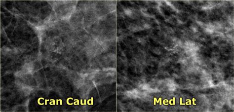 The Radiology Assistant Differential Of Breast Calcifications