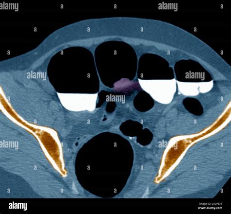 Colon Cancer Coloured Barium Contrast Computed Tomography Ct Scan Of