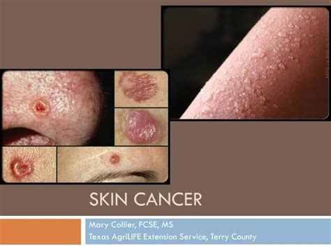 Ppt Skin Cancer Powerpoint Presentation Free Download Id3634974