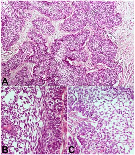 Malignant Ameloblastoma A Challenging Diagnosis