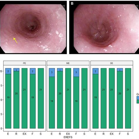 Eosinophilic Esophagitis Histologic Scoring System Eoehss