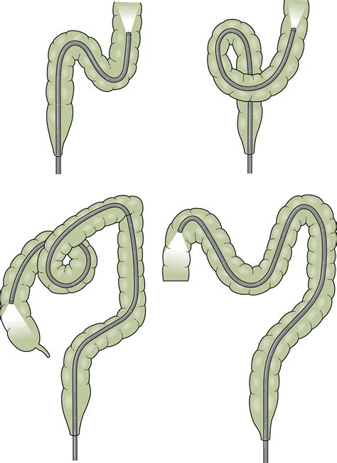 Colonoscopy Polypectomy And Related Techniques Clinical Tree