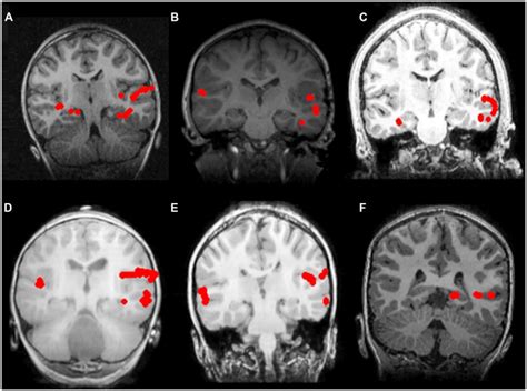 Receptive Language Mapping With Meg With And Without Sedation Language