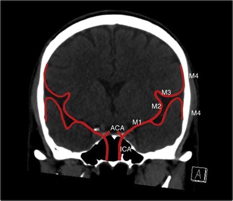 Cerebral Circulation 1 Anatomy Pmc