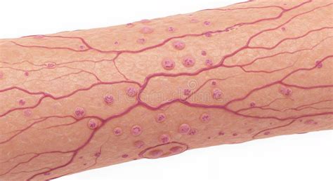 Detailed Medical Image Of Livedo Reticularis Showing Purplish Net Like